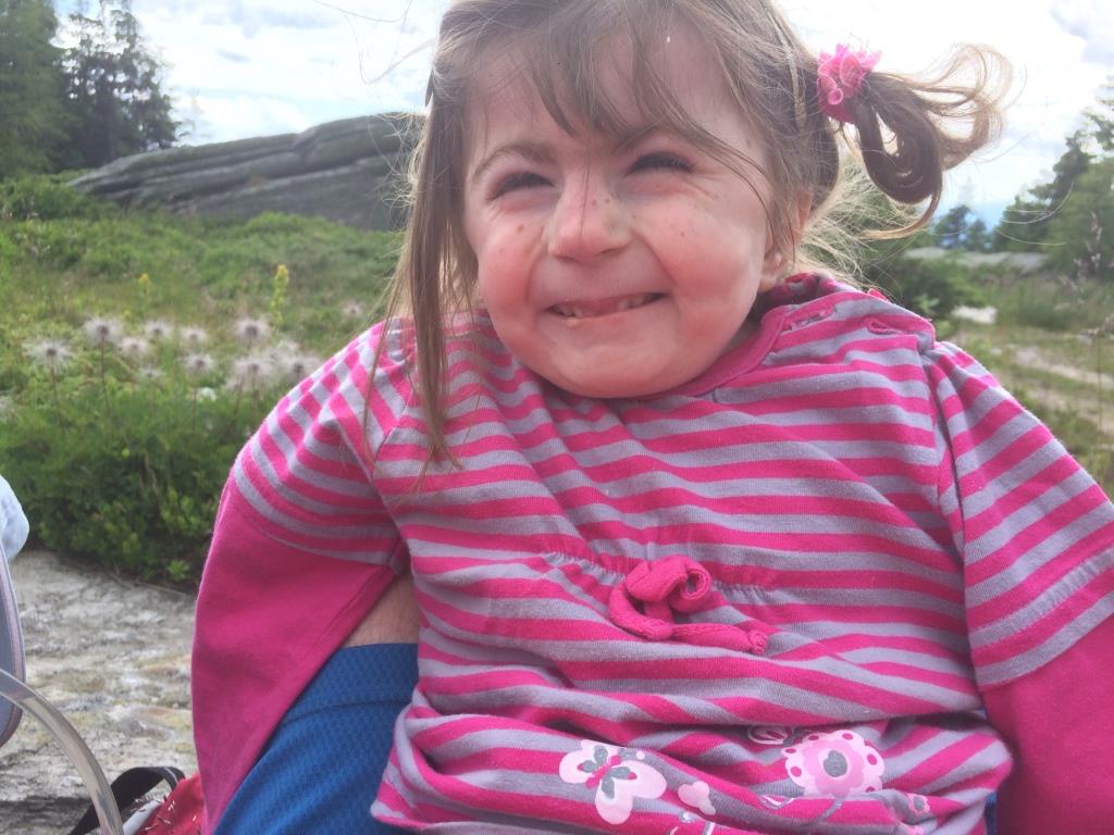 Burnside Butlerov syndróm | Genetické syndrómy