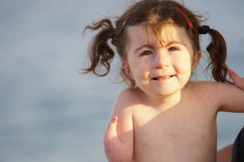 Turnerov syndróm | Genetické syndrómy