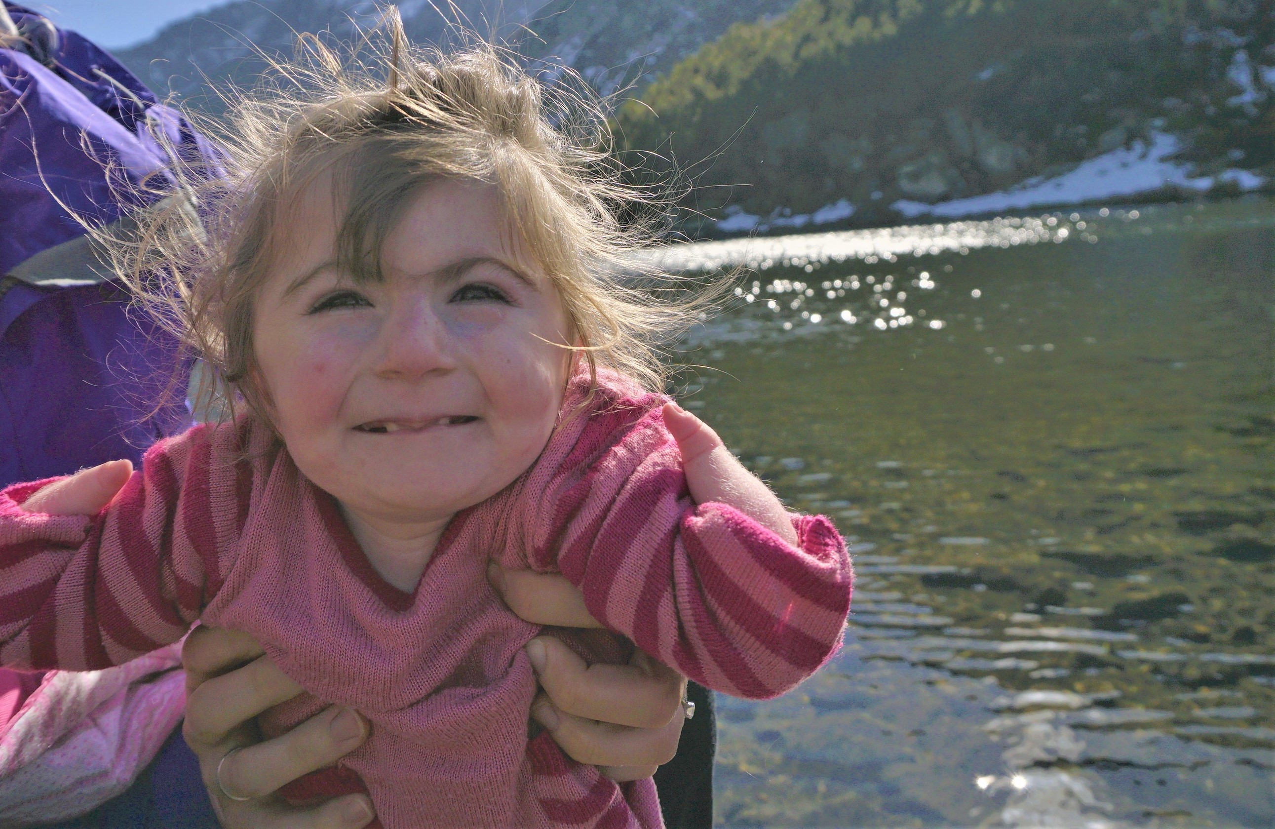 Turnerov syndróm | Genetické syndrómy