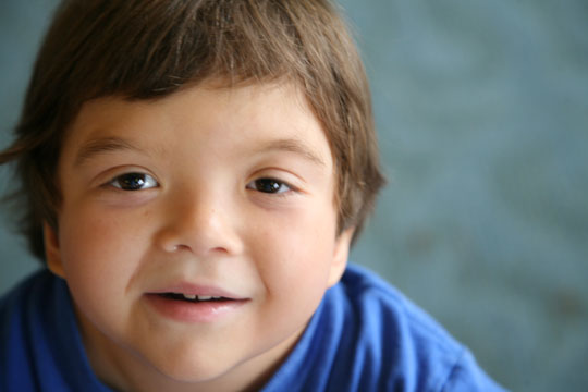 Noonanov syndróm - Male-Turnerov syndróm | Genetické syndrómy