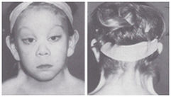 Turnerov syndróm | Genetické syndrómy