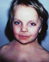 Turnerov syndróm | Genetické syndrómy