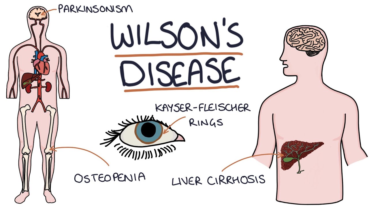 Wilsonova choroba - Hepatolentikulárna degenerácia Í Genetické syndrómy