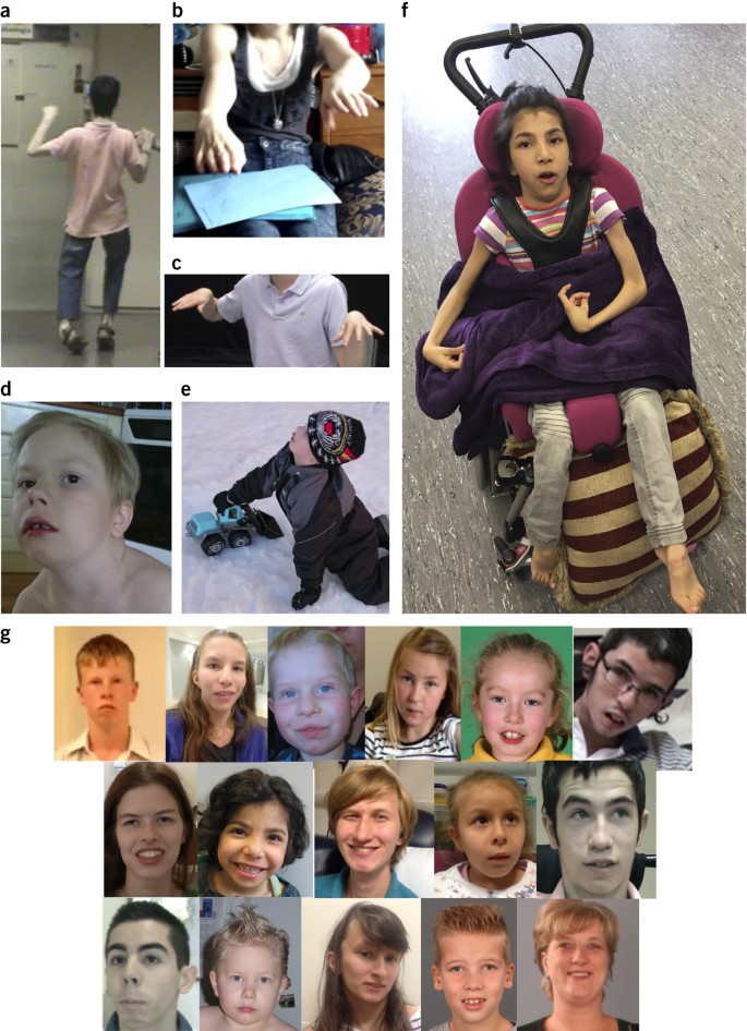 KMT2B syndróm | Genetické syndrómy