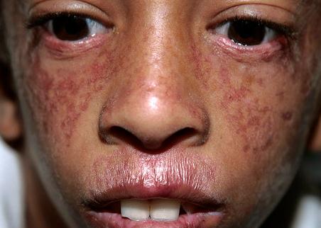 Bloomov syndróm | Genetické syndrómy