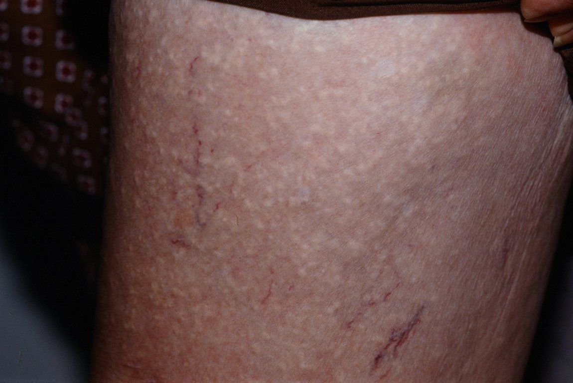 Buschke-Ollendorffov syndróm | Genetické syndrómy