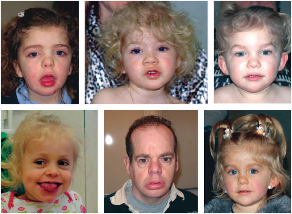 Coffin-Sirisov syndróm | Genetické syndrómy